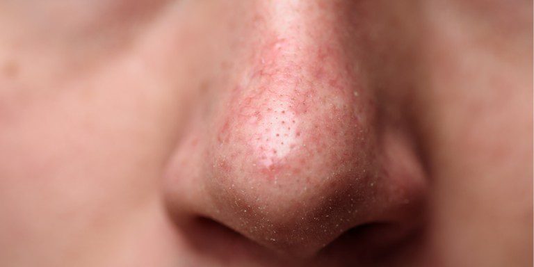Myth Vs Fact Is Drinker s Nose A Real Condition myth-vs-fact-is-drinker-s-nose-a-real-condition